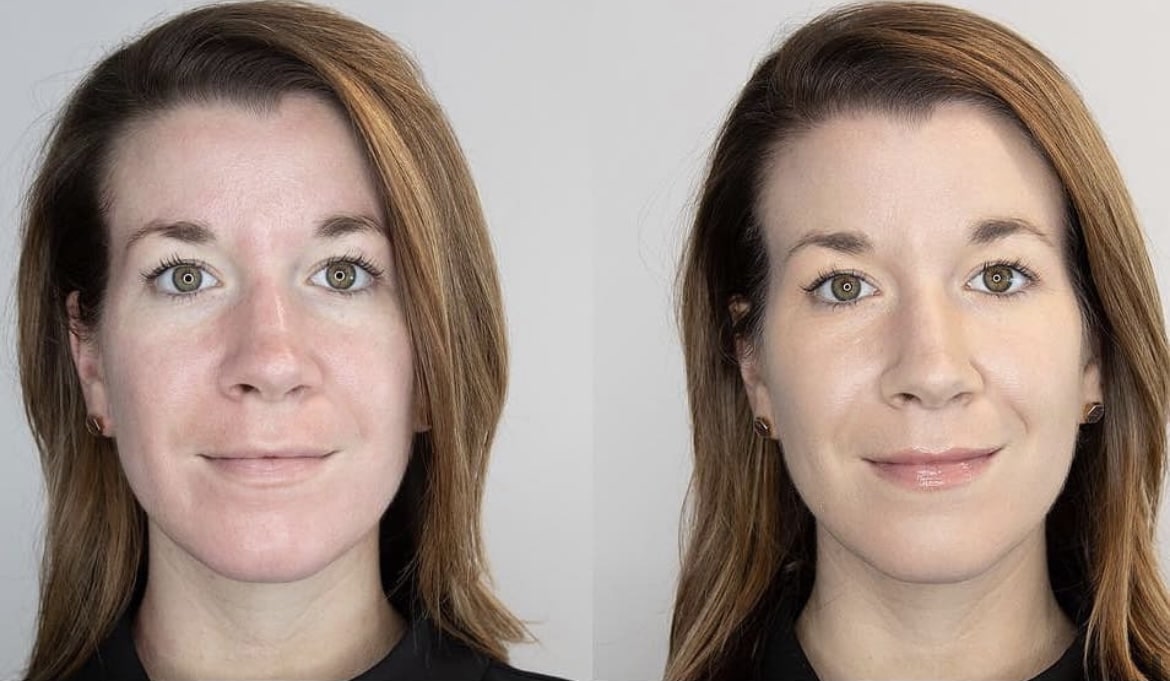 Finishing Touch™ Protocol | Calkin & Boudreaux Dermatology Associates