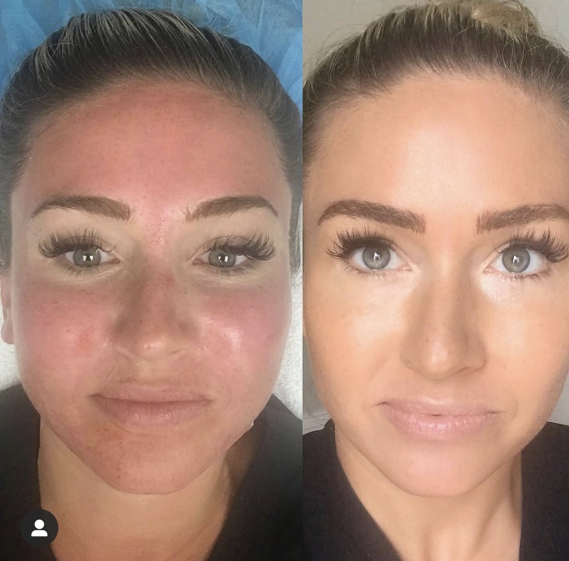 Finishing Touch™ Protocol | Calkin & Boudreaux Dermatology Associates