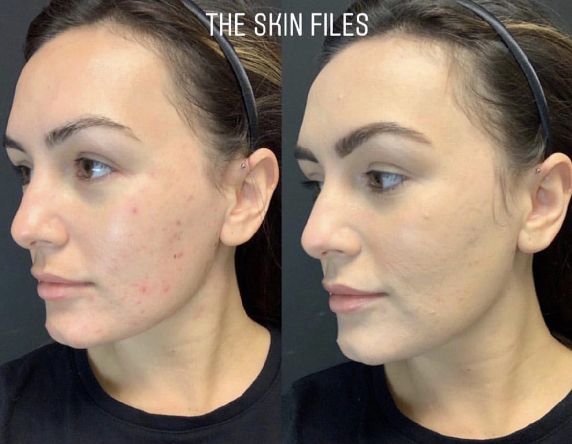 Finishing Touch™ Protocol | Calkin & Boudreaux Dermatology Associates