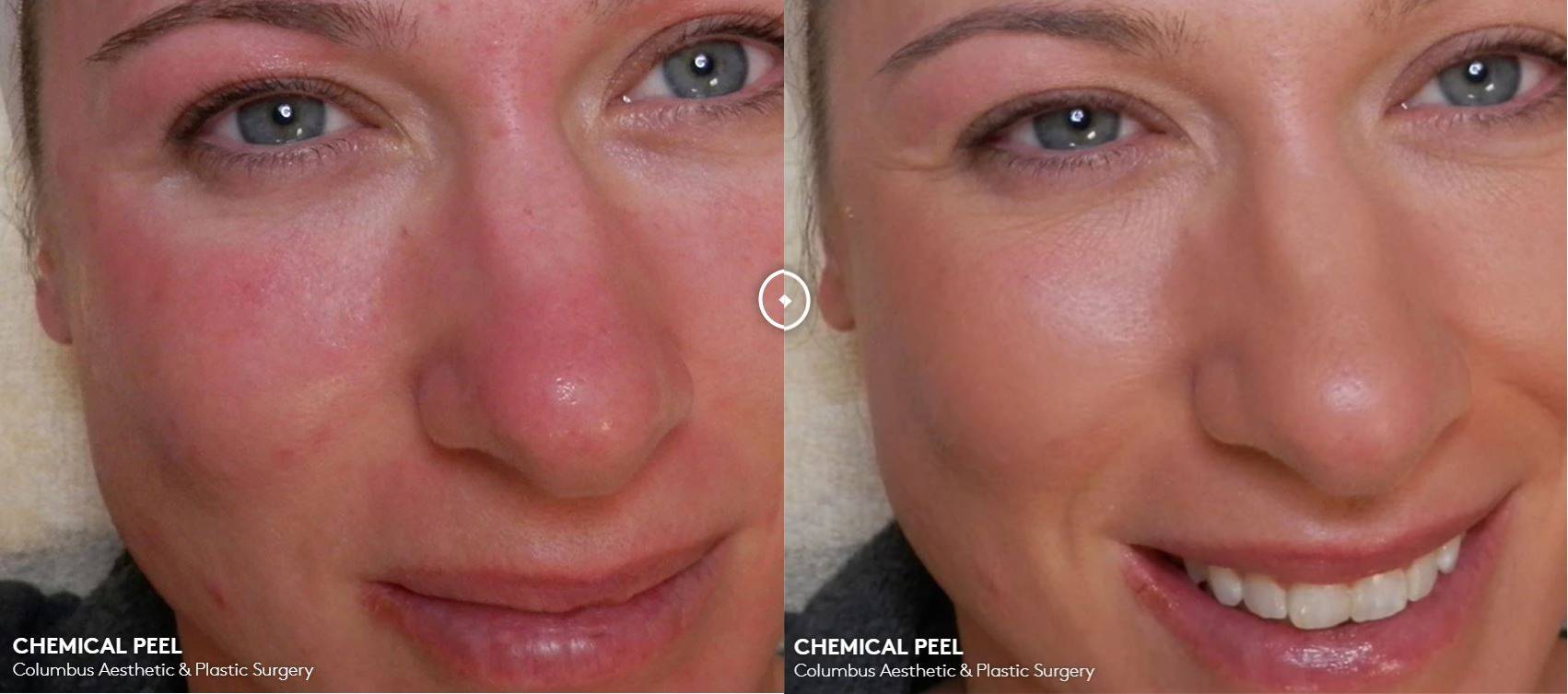 Finishing Touch™ Protocol | Calkin & Boudreaux Dermatology Associates