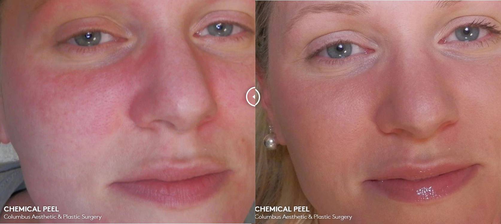 Finishing Touch™ Protocol | Calkin & Boudreaux Dermatology Associates