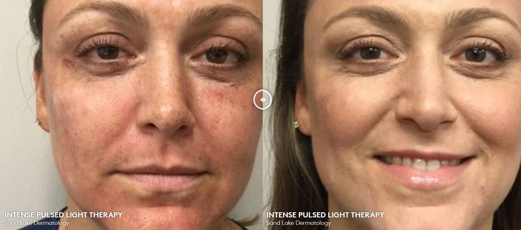 Finishing Touch™ Protocol | Calkin & Boudreaux Dermatology Associates