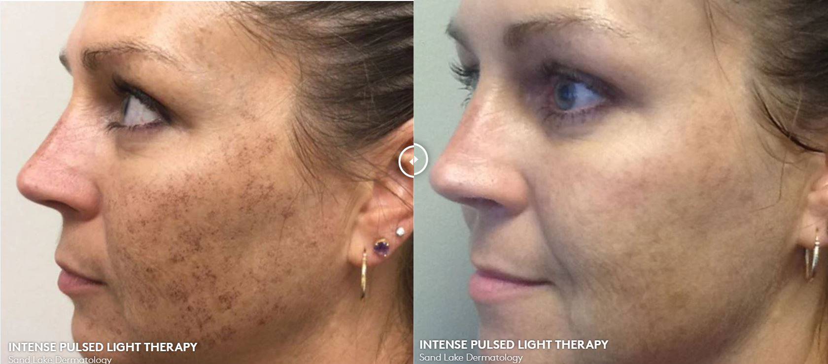 Finishing Touch™ Protocol | Calkin & Boudreaux Dermatology Associates