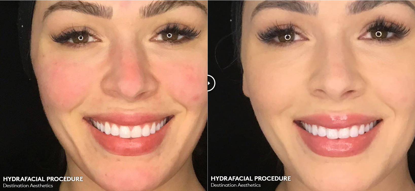 Finishing Touch™ Protocol | Calkin & Boudreaux Dermatology Associates