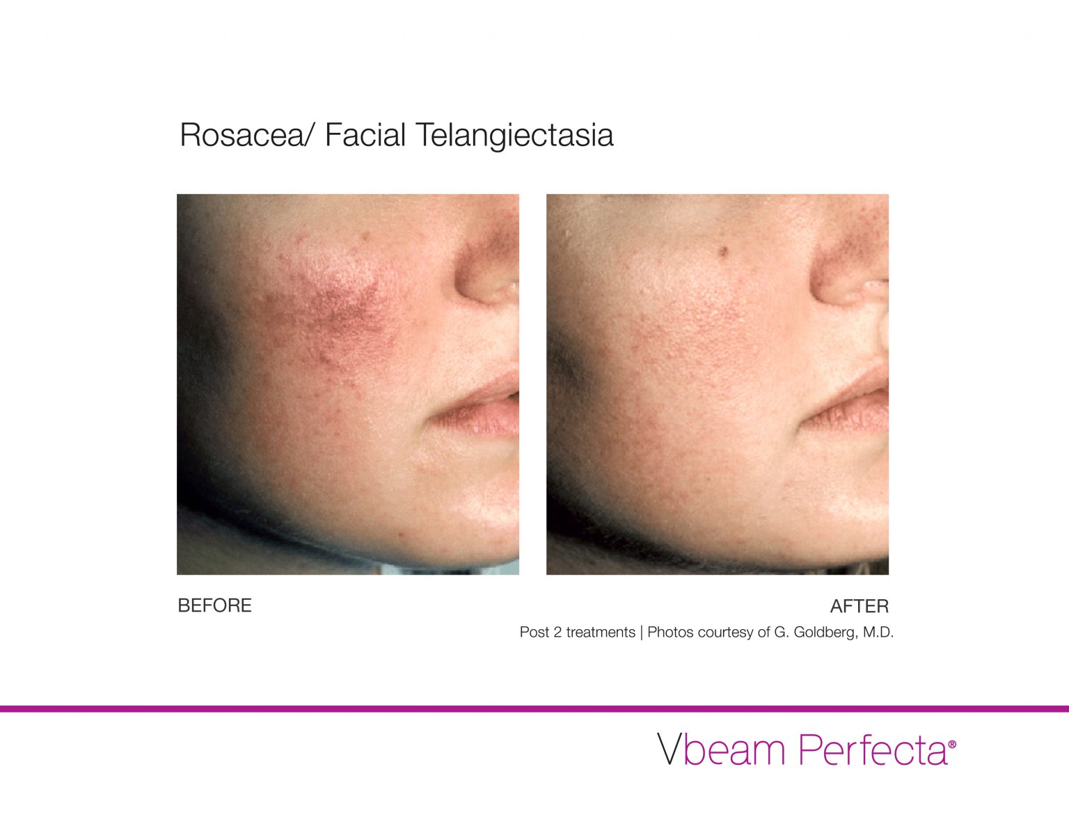 Vbeam Perfecta | Calkin & Boudreaux Dermatology Associates