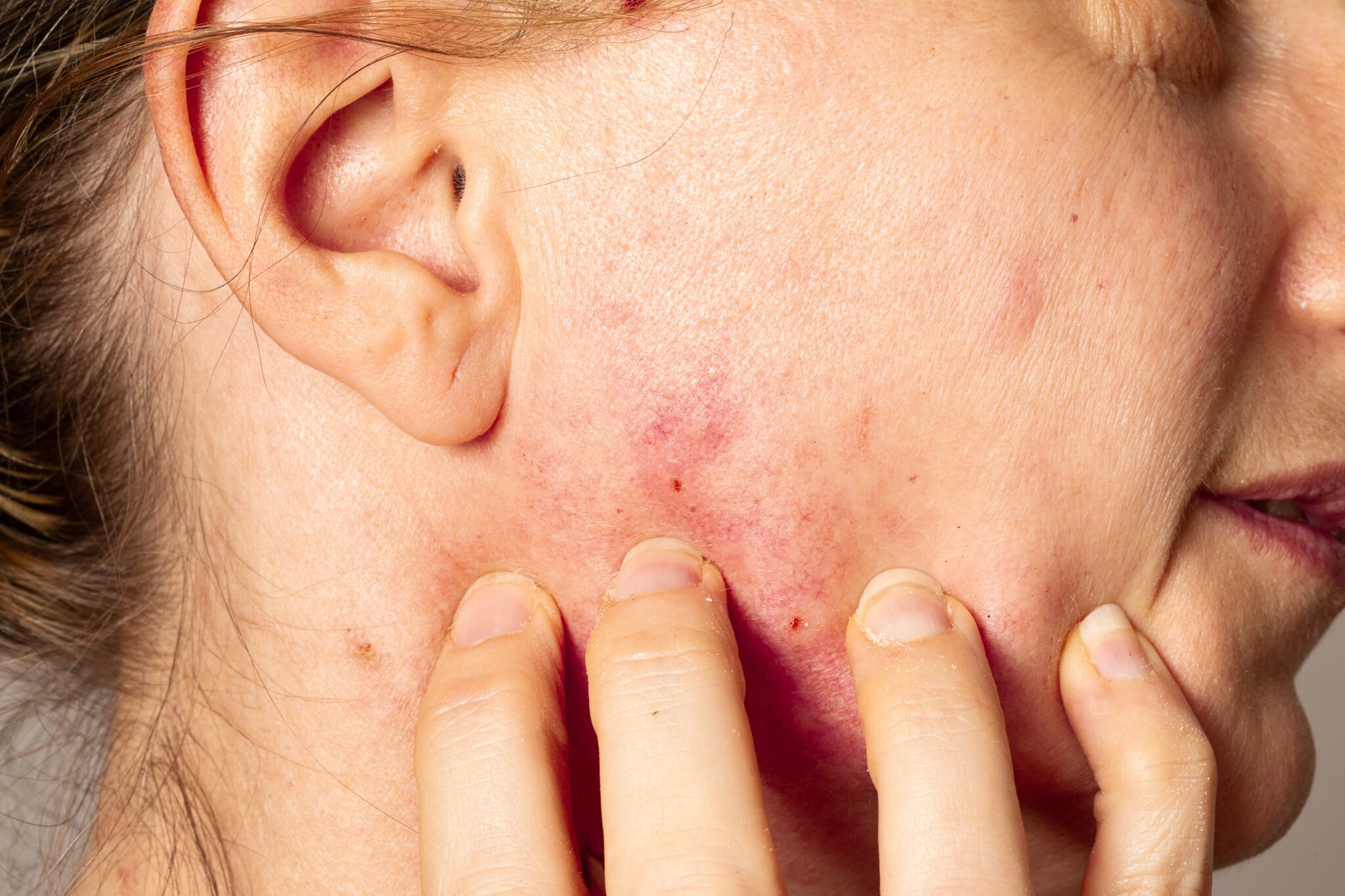 6 Tips for Managing and Living with Rosacea | Calkin & Boudreaux ...