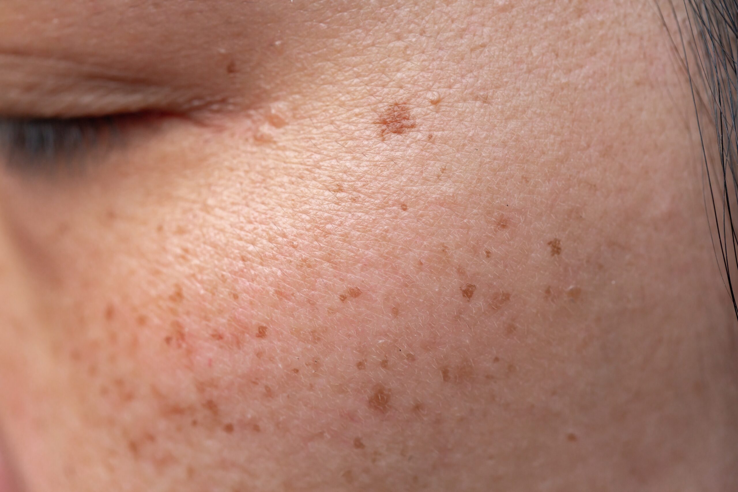 How to Get Rid of Age Bumps on the Face | Calkin & Boudreaux ...