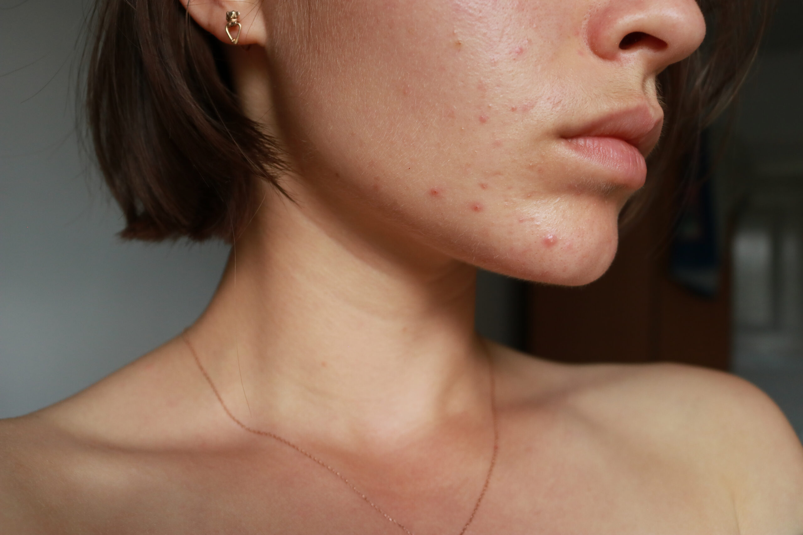 Everything You Need to Know About Adult Acne | Calkin & Boudreaux ...