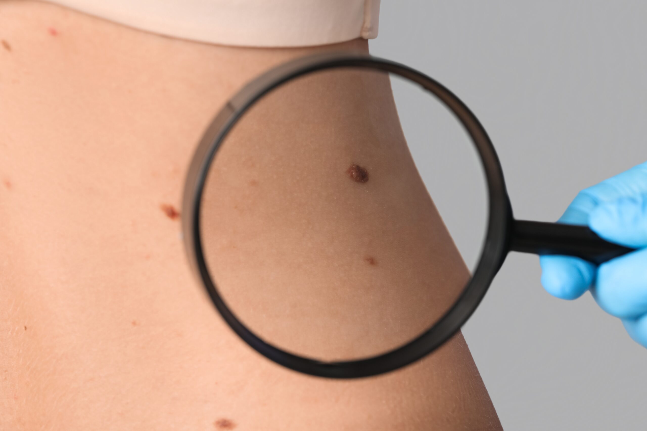 Critical Signs of Skin Cancer You Shouldn't Ignore | Calkin & Boudreaux ...
