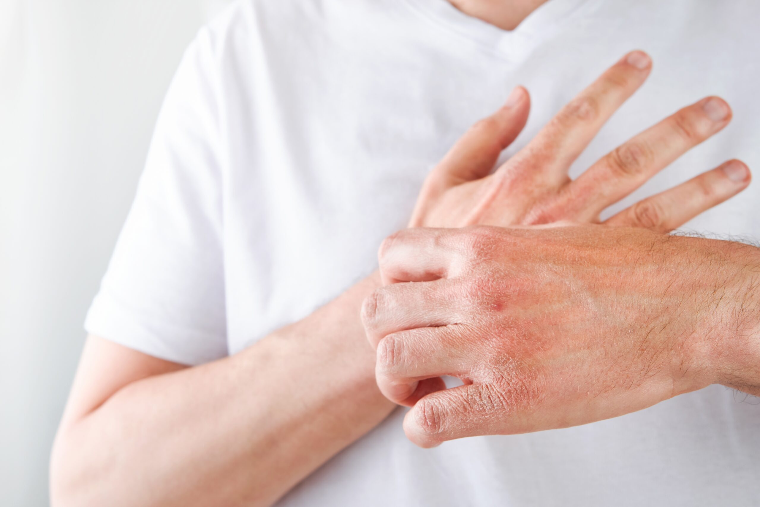 7 Natural Remedies for Eczema to Try | Calkin & Boudreaux Dermatology ...